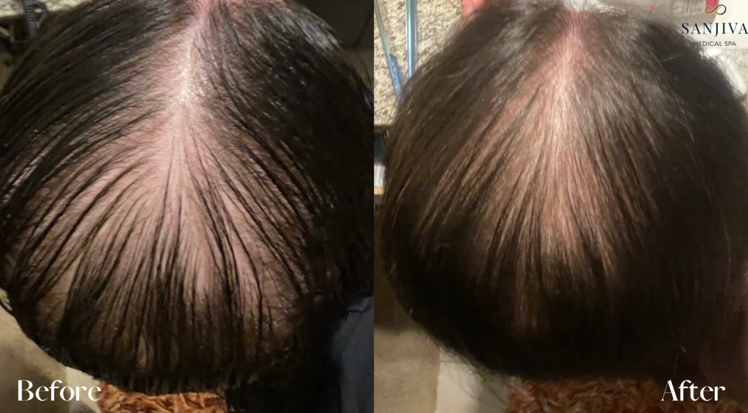 Exosomes for Hair Loss Treatment in Dallas: The Latest in Hair Regrowth ...