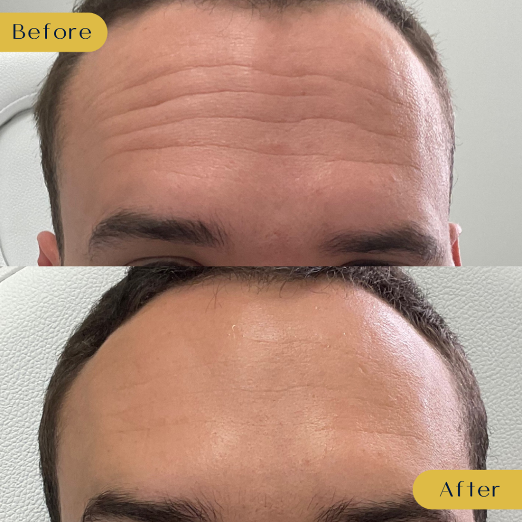 Best Botox® Injections in Dallas | $14/Unit | Sanjiva Medical Spa